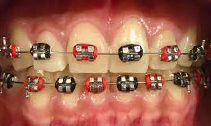 Red and Black Braces to Express Your Unique Orthodontic Style